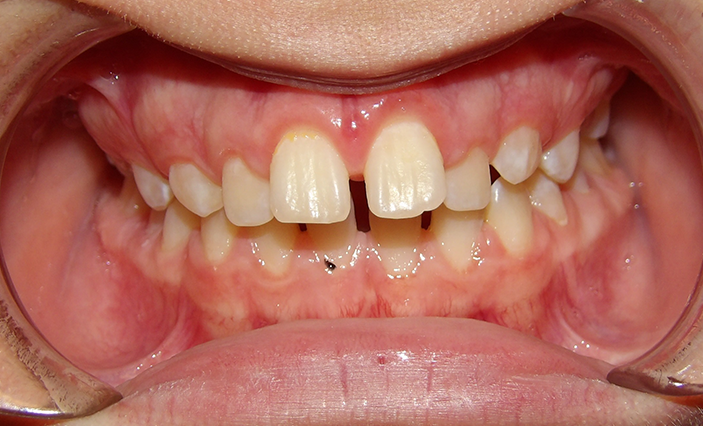 Before & Afters - Adult & Pediatric Orthodontics